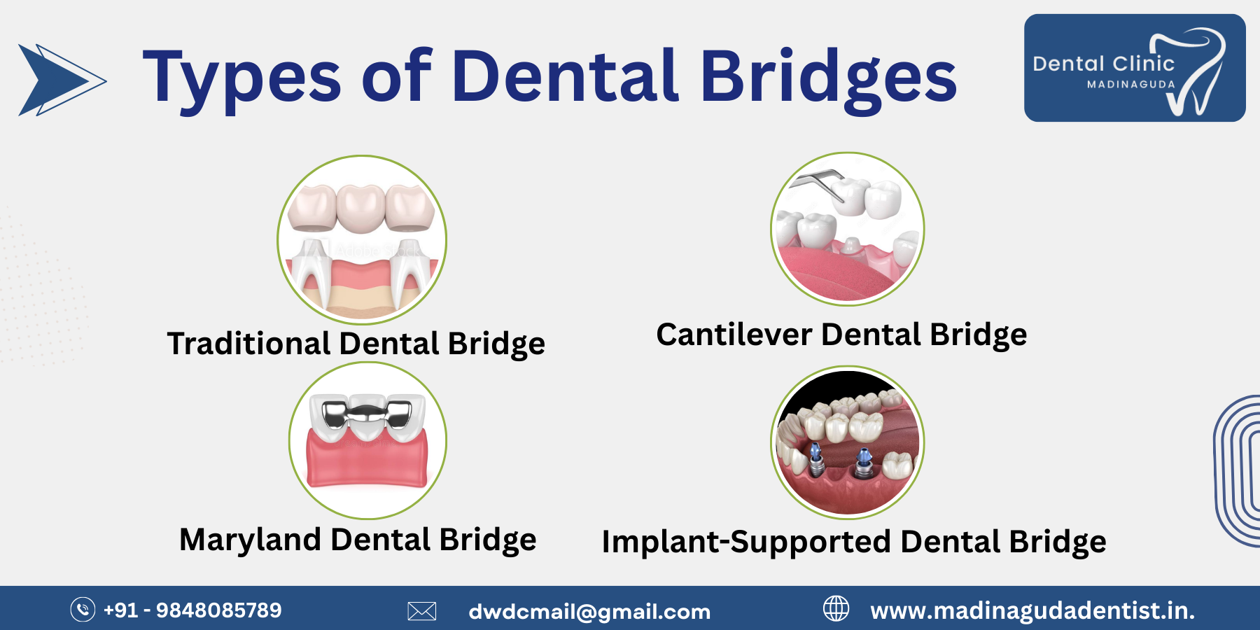 what is dental bridging - Types, Cost, Procedure, Benefits.
